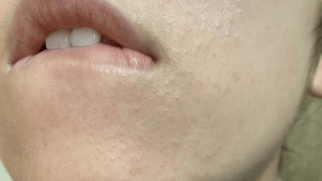 Hair Follicles Bumps